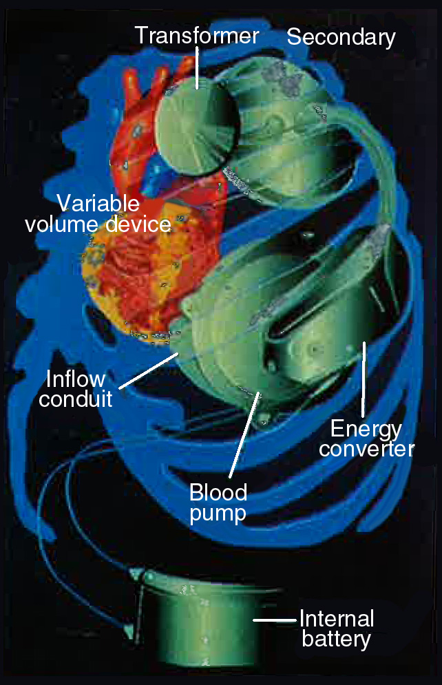 Artificial heart presents unusual design challenges | Power & Motion Tech